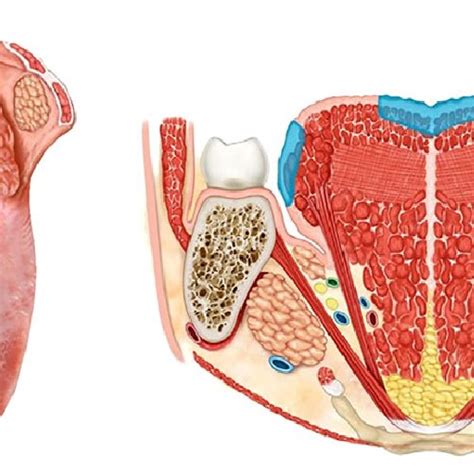 Pdf Classification Of Glossectomies A Proposal For Tongue Cancer