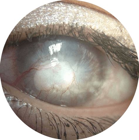 Information On Contact Lenses Comparing 13 Brands Ask Eye Doc