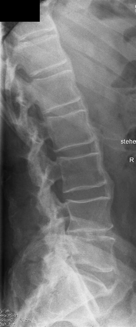Diffuse Idiopathic Skeletal Hyperostosis Norway PDF PPT Case Reports Symptoms Treatment