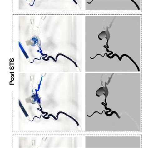 Comparison Between The Dsa Images And Cfd Results Showing The Contrast Download Scientific