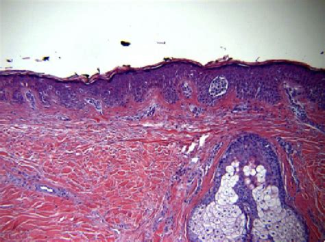 Figure 1 From Early Diagnosis Of Multiple Primary Amelanotic Hypomelanotic Melanoma Using