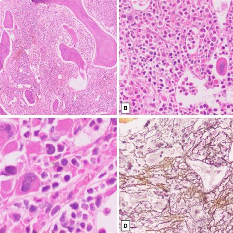 A Markedly Hypercellular Marrow With Dilated Sinusoids Hande