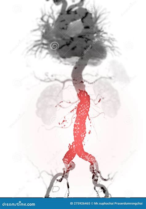 Cta Whole Aorta With Abdominal Aorta Stent Graft 3d Rendering Image In Case Abdominal Aortic
