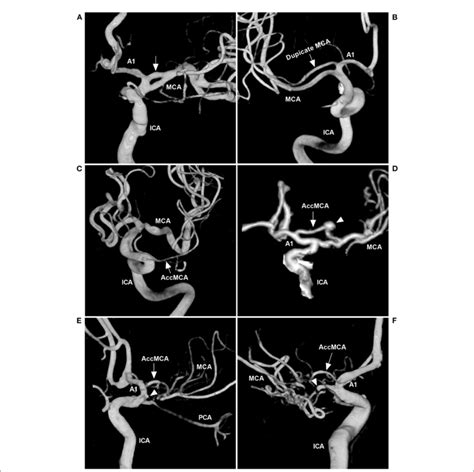 Figure Mca Anomalies On Angiography A Three Dimensional Dsa Of The Download Scientific