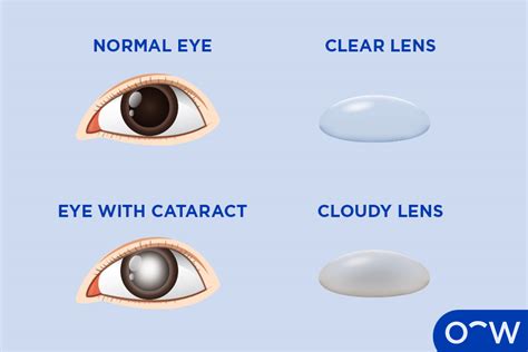 Cataract Definition