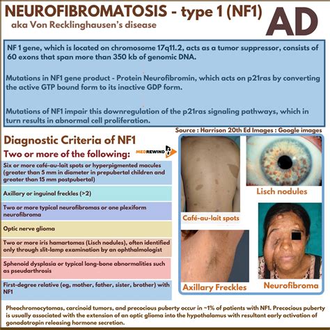 Neurofibromatosis Type 1 Lisch Nodules Neurofibromatosis Type 1 Lisch Nodules