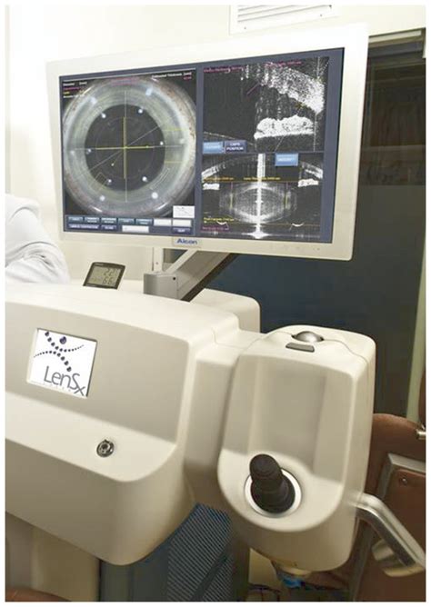 27 Optical Coherence Tomographyassisted Anterior Segment Surgery Ento Key