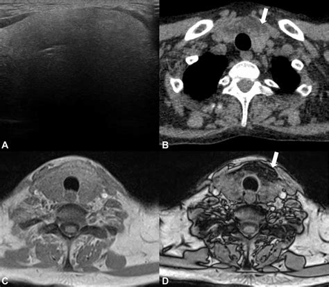 A Sonography Reveals A Diffusely Enlarged Thyroid With Marked Acoustic Download Scientific