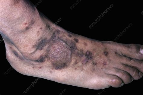 Pigmented Purpuric Dermatosis Stock Image C0517460 Science Photo