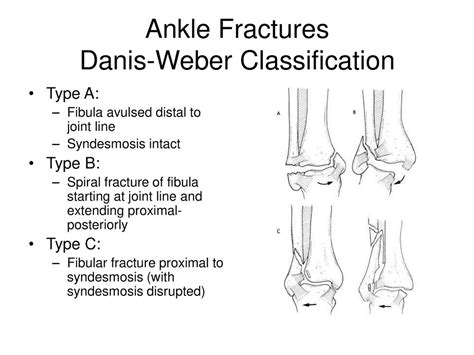 كسور الكاحل و القدم عند الكبار Ppt Download