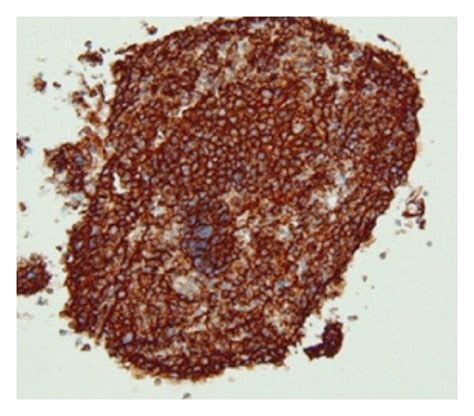 Endoscopic Ultrasonography Demonstrated An Enlarged Perigastric Lymph