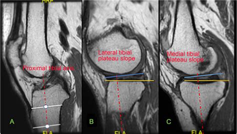 Importance Of Posterior Tibial Slope Medial Tibial Plateau Slope And
