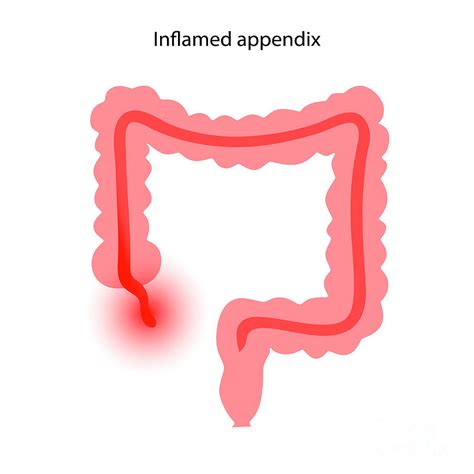 Inflamed Appendix Photograph By Pikovit Science Photo Library Pixels
