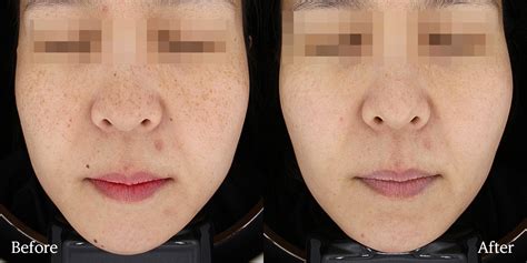 기미·잡티 치료 전·후사진 맑은우리피부과의원