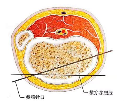 一文了解 胫骨近端骨折：环形外固定架固定架克氏针膝关节胫骨骨折 健康界
