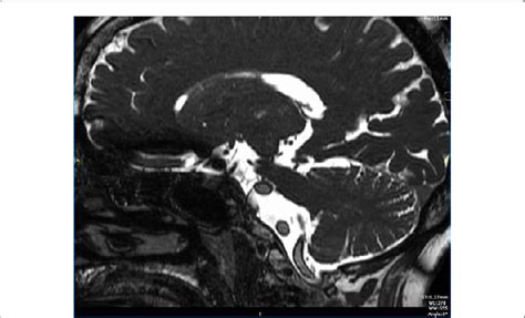 Cisternal Segment Of Left Sixth Nerve Is Displaced Superiorly By The