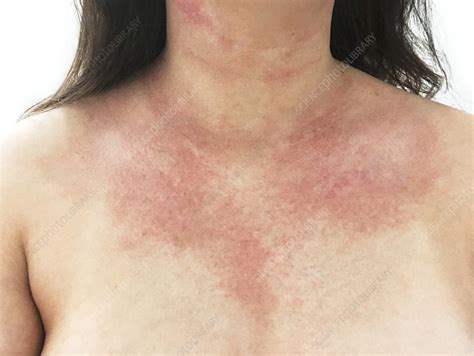 Dermatomyositis Chest