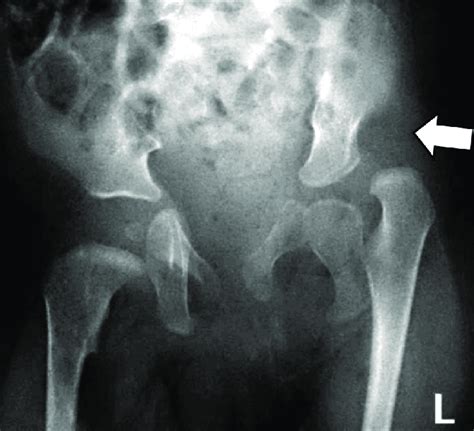 Preoperative Plain Radiographs Of The Pelvis Showing Left Hip