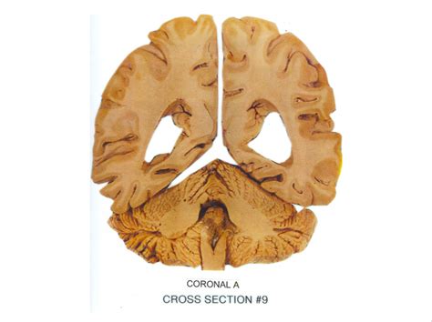 Brain Section Coronal 9 Diagram Quizlet Brain Section Coronal 9 Diagram Quizlet