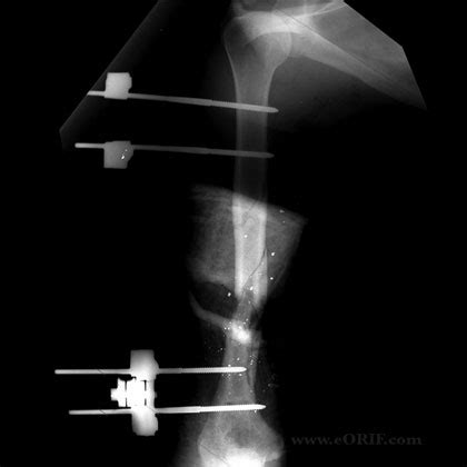 Humeral Shaft External Fixation EORIF