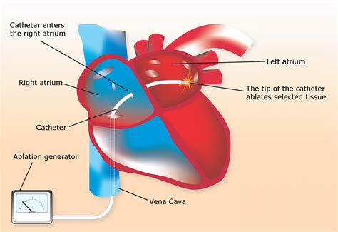 Understanding Your Ablation Options Choices For Afib Atrial Flutter And More Monarch Heart