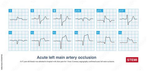 Acute Left Main Artery Occlusion Can Cause Both St Segment Elevation And Non St Segment