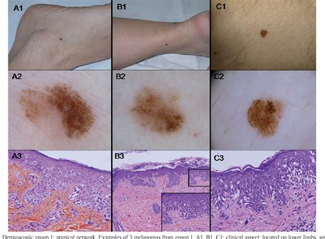 Early Stage Melanoma Pictures