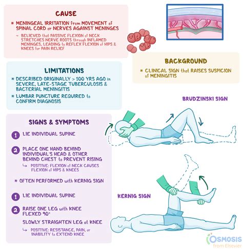Brudzinski Sign
