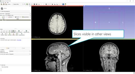 Visualizing MRI CT Scans In Mixed Reality VR AR Part Segmenting The Brain