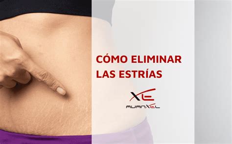 Cómo Eliminar Las Estrías