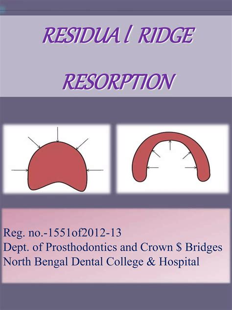 Residual Ridge Resorption Pptx