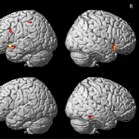Voxel Based Morphometry Vbm Lower Gray Matter Volume In Older Women Download Scientific