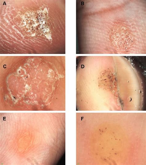 Different Patterns Of Palmer Warts Under The Dermoscope A Frogspawn