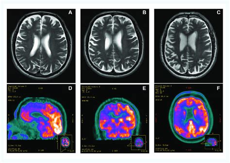 Representative T 2 Weighted Magnetic Resonance Imaging Brain Axial Download Scientific Diagram