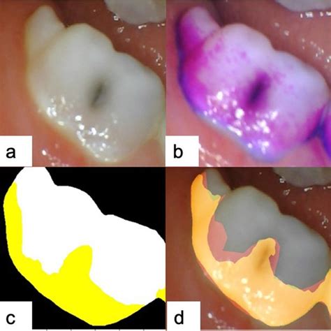 Pdf Deep Learning Based Dental Plaque Detection On Primary Teeth A Comparison With Clinical