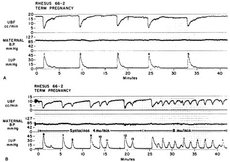Labor Contractions Chart Ponasa