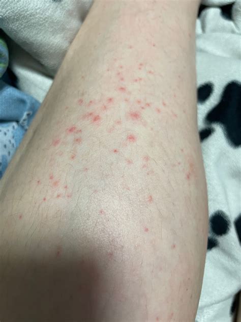 피부 두드러기가 생겨 질문 드립니다 지식in