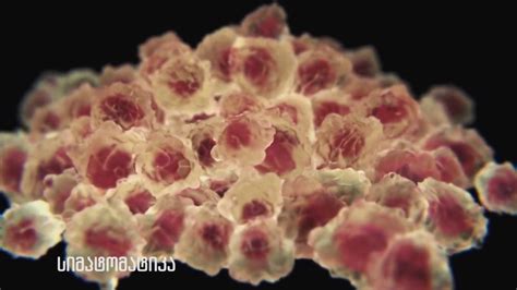 როგორ ვითარდება სიმსივნე Youtube