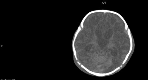 A Spiral Brain Ct Scan Showed Brain Atrophy Hydrocephalus And White Download Scientific