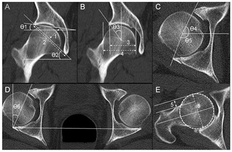 The Association Between Hip Joint Morphology And Posterior Wall Fracture Analysis Of Radiologic