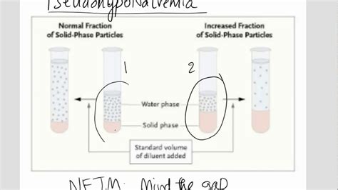 Pseudohyponatremia Falsely Low Sodium Concentration Youtube