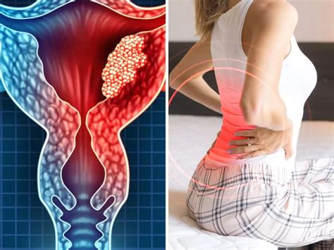 Does White Spots On Cervix Mean Cancer Presswire
