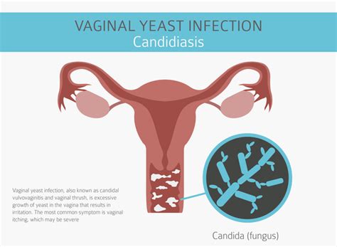 Vaginal Opening Yeast Infection