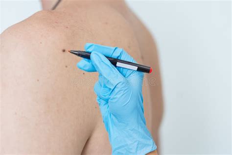 Psoriasis Skin Disease Is A Dermatic Problem Red Allergic Skin Rash