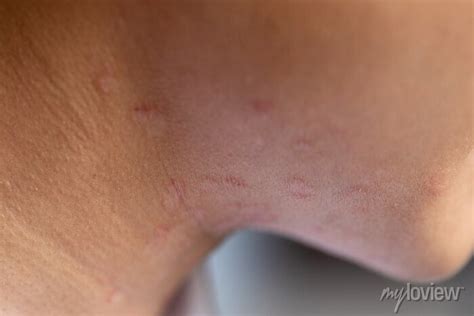 Tinea Circinata Or Ringworm On The Head Wall Mural • Murals