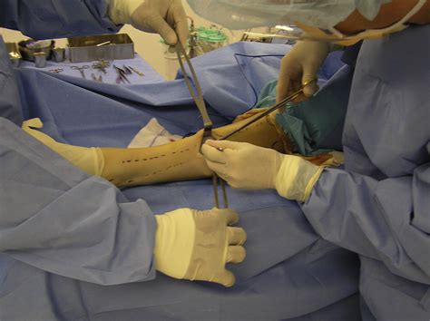 Compartment Syndrome Recovery After Surgery At Isaac Dadson Blog