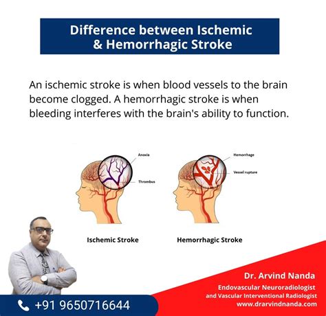 Dr Arvind Nanda — Difference Between Ischemic And Hemorrhagic Stroke