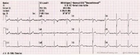 Types Of ECG Artifacts Understanding Interference