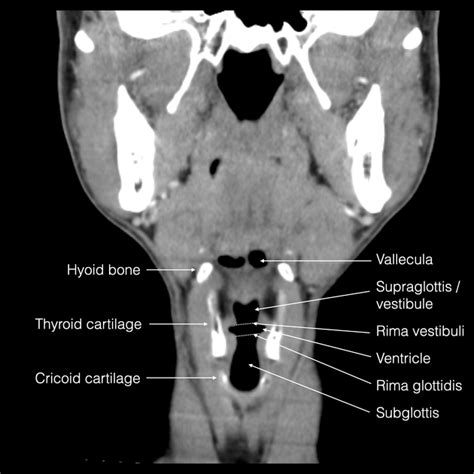 Lamina Cartilage Thyroid