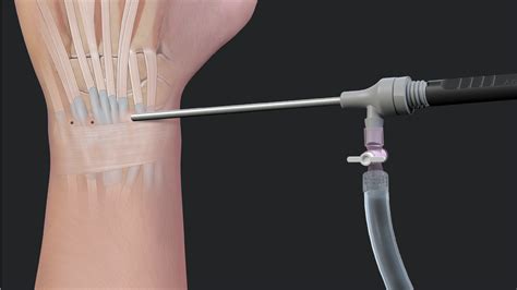 Arthrex - Comprehensive NanoNeedle Arthroscopy Portfolio